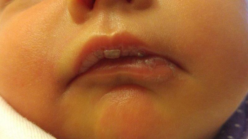 Why My Baby Has Chapped Lips | Lipstutorial.org