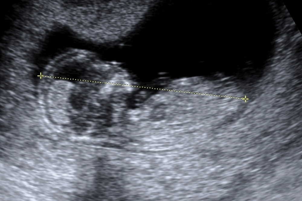 Does A Baby Fetus Have Gills In The Womb?